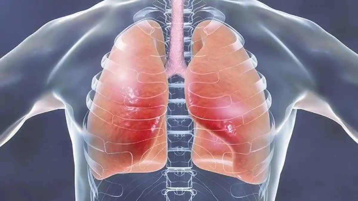 Apakah Fibrosis Paru Bisa Disembuhkan Secara Total? Begini Penjelasan Dokter - TribunNews.com