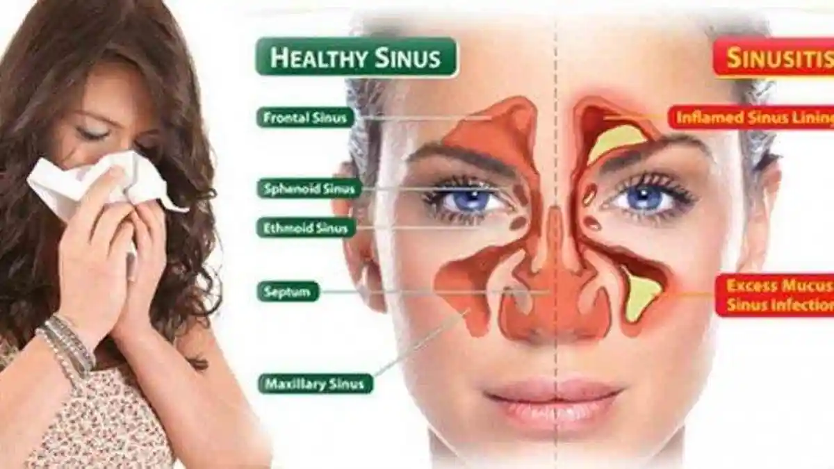 Berikut Ini Faktor Pemicu Sinusitis Bisa Kambuh Menurut Dokter ...