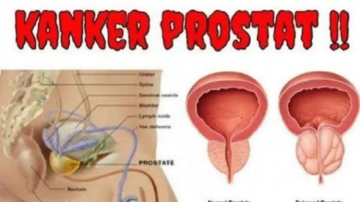 Kenali Gejala Kanker Prostat, Banyak Dialami Pria, Hanya Bisa Ditangani ...